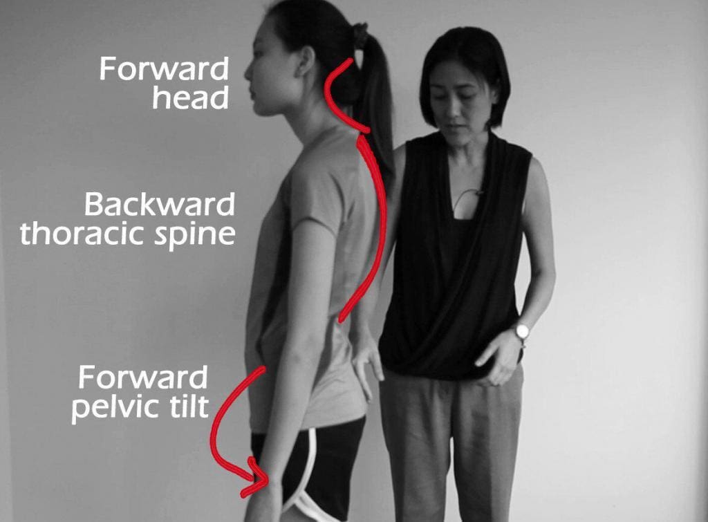 Sway back posture - a leading poor posture type causing back pain