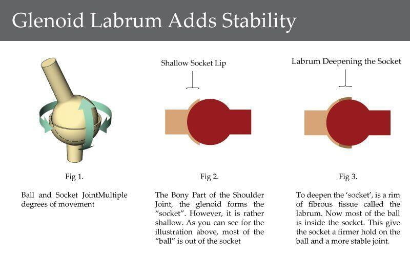 Understanding Shoulder Tears