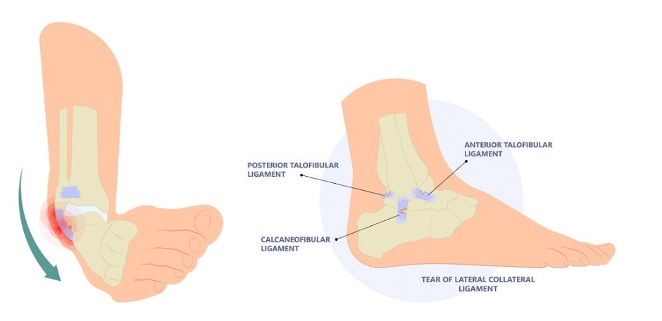 Basketball Injuries - 3 Common Injuries & How Physio Can Help